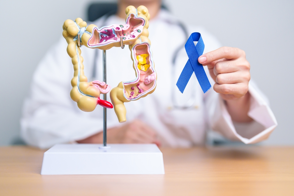 Why Colon Cancer Screening is Essential for Your Health - Advanced ...